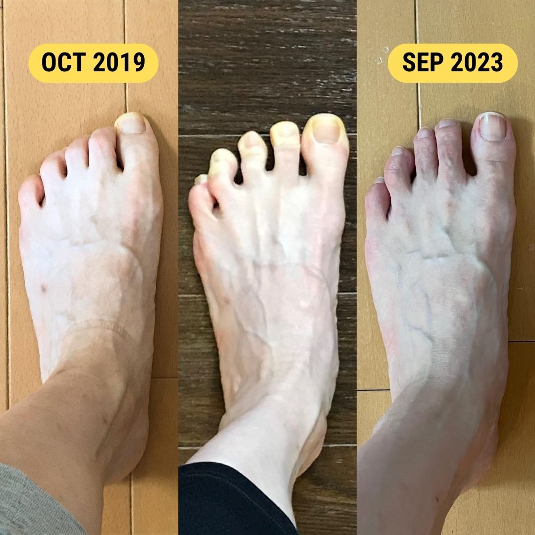 A Year In Barefoot Shoes: The Astonishing Before And After Results ...