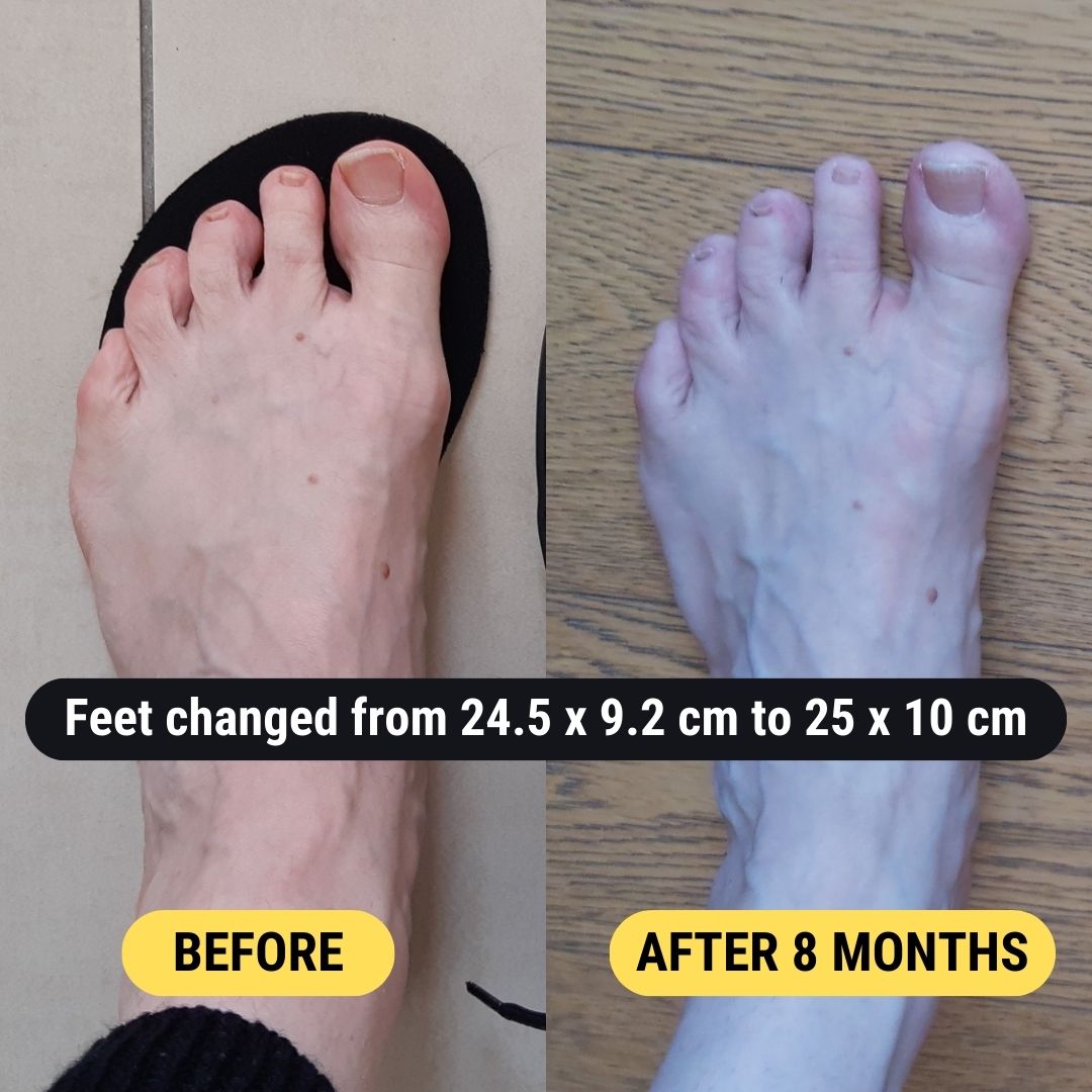 A Year In Barefoot Shoes: The Astonishing Before And After Results ...