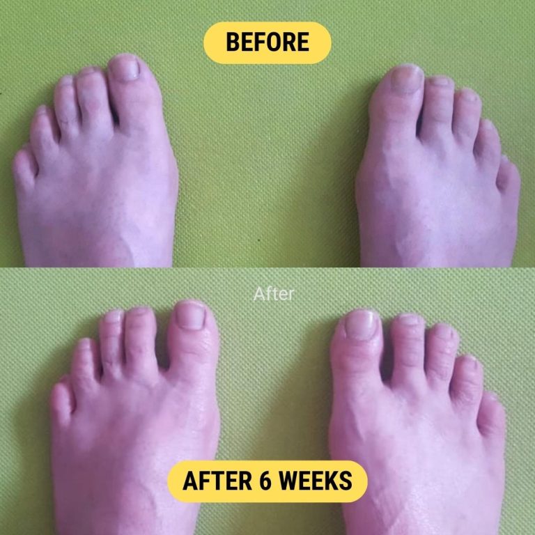 A Year In Barefoot Shoes: The Astonishing Before And After Results ...