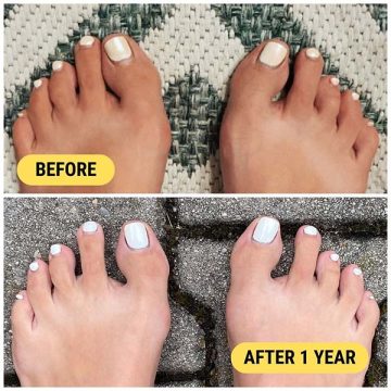 A Year In Barefoot Shoes: The Astonishing Before And After Results ...