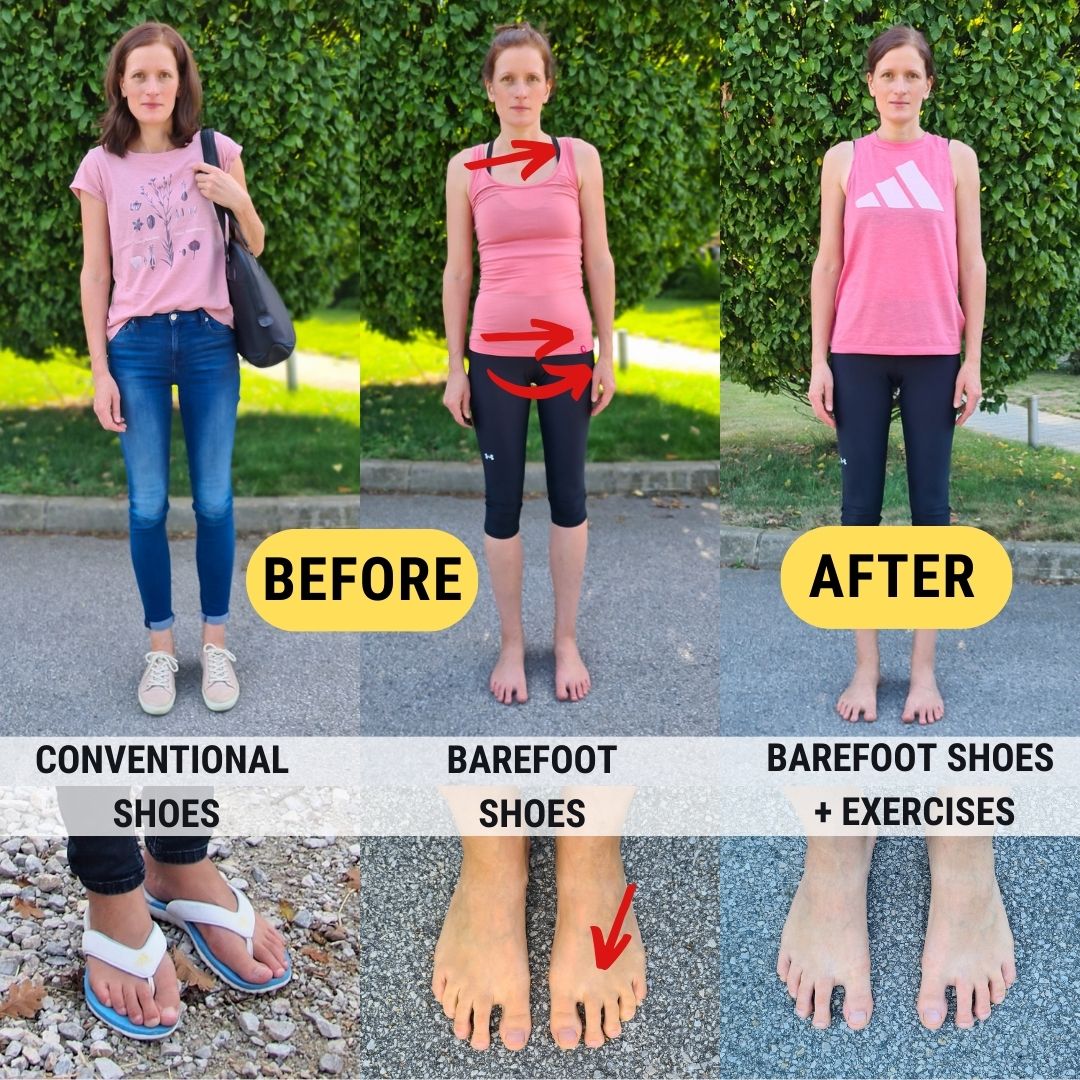 A Year In Barefoot Shoes: The Astonishing Before And After Results ...
