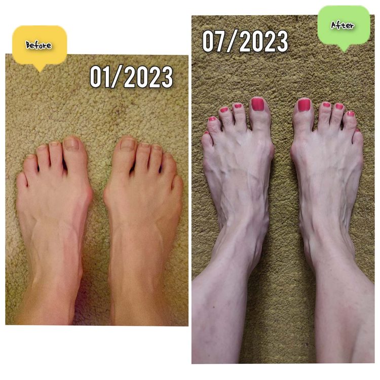 A Year In Barefoot Shoes: The Astonishing Before And After Results ...