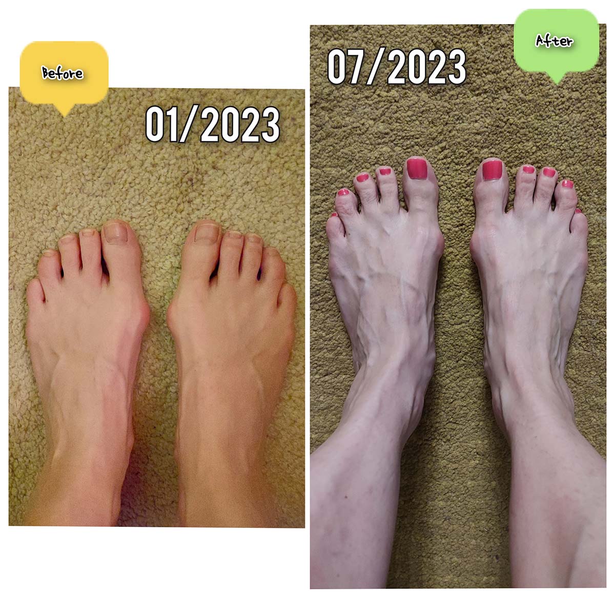 A Year In Barefoot Shoes: The Astonishing Before And After Results ...