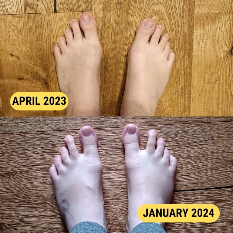 A Year In Barefoot Shoes: The Astonishing Before And After Results ...
