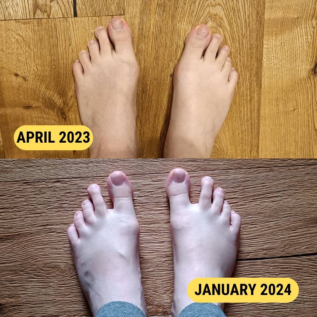 A Year In Barefoot Shoes: The Astonishing Before And After Results ...